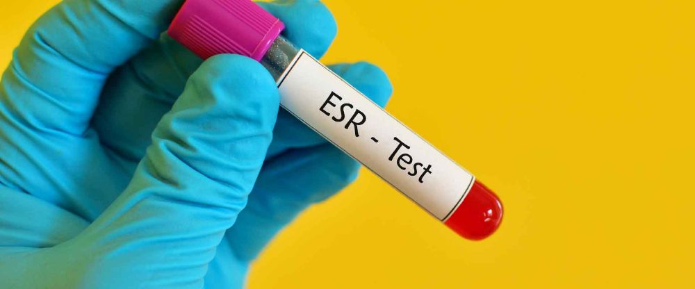 آزمایش ESR چیست؟ - ویرگول